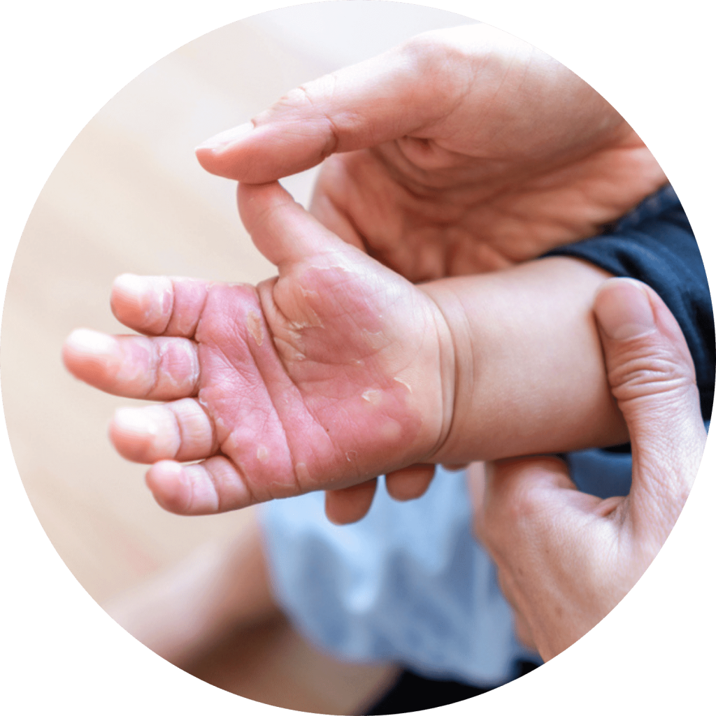 New York Burn Injury Lawyers | Harris Keenan & Goldfarb